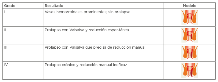 Manejo de la Enfermedad Hemorroidal - European Medical Journal
