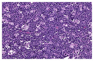 Double-Hit and Triple-Hit Lymphomas: New Perspectives for Their ...