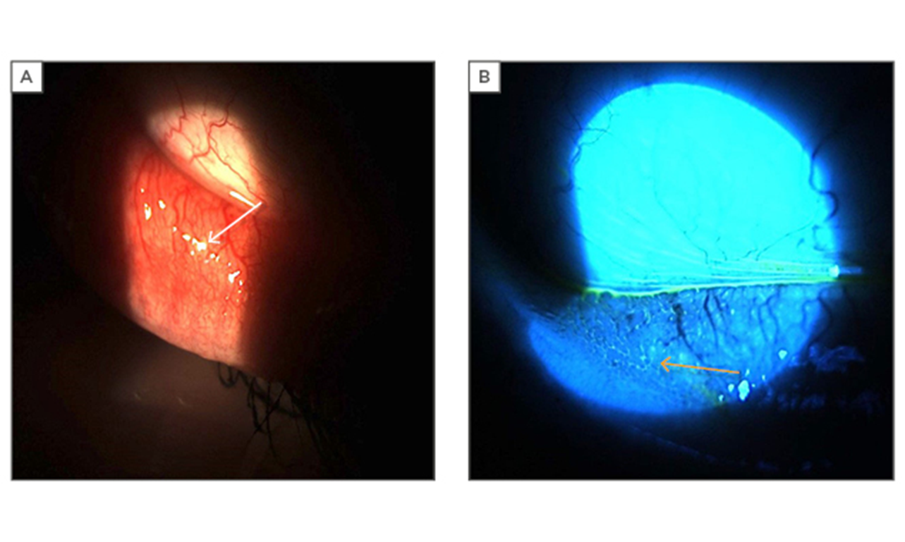 Immunopathology of Allergic Conjunctivitis - European Medical Journal