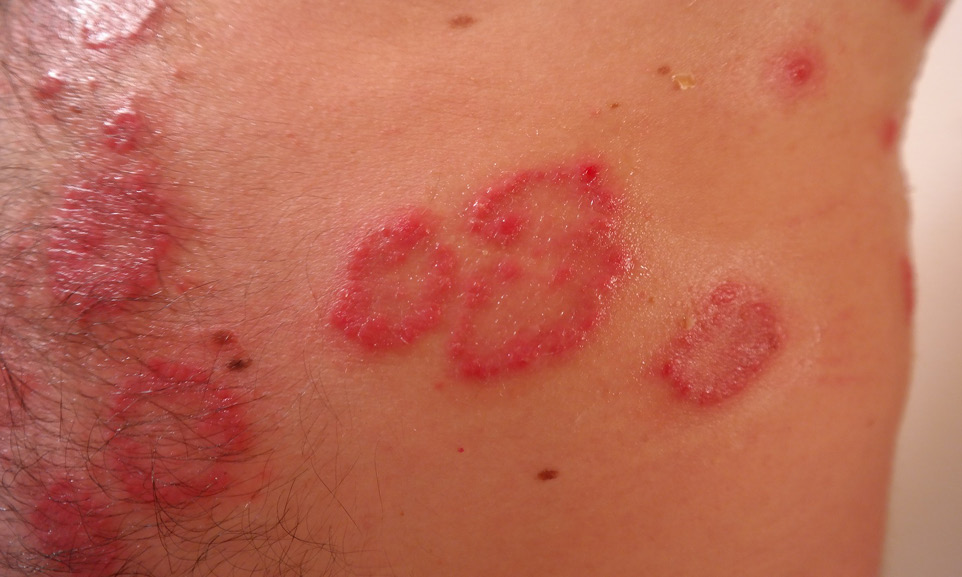 Recommendation Given for New Psoriasis Treatment - European Medical Journal