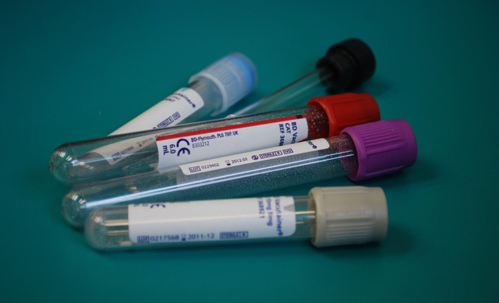 Blood Test in Prostate Cancer Detection - European Medical Group