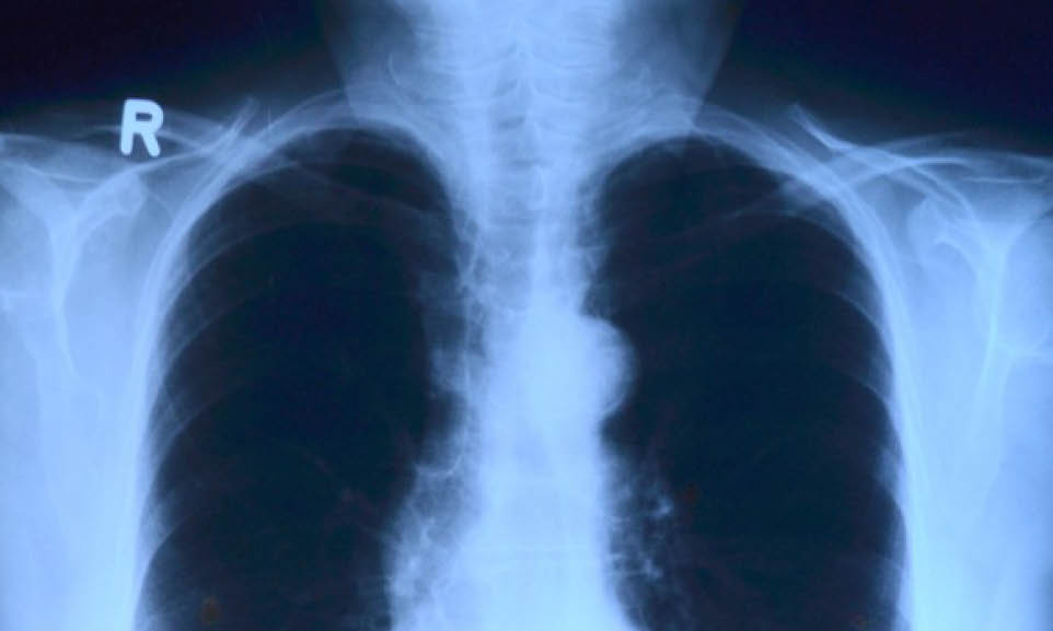 Portable Breath Monitor And Acute Respiratory Distress Syndrome - EMG
