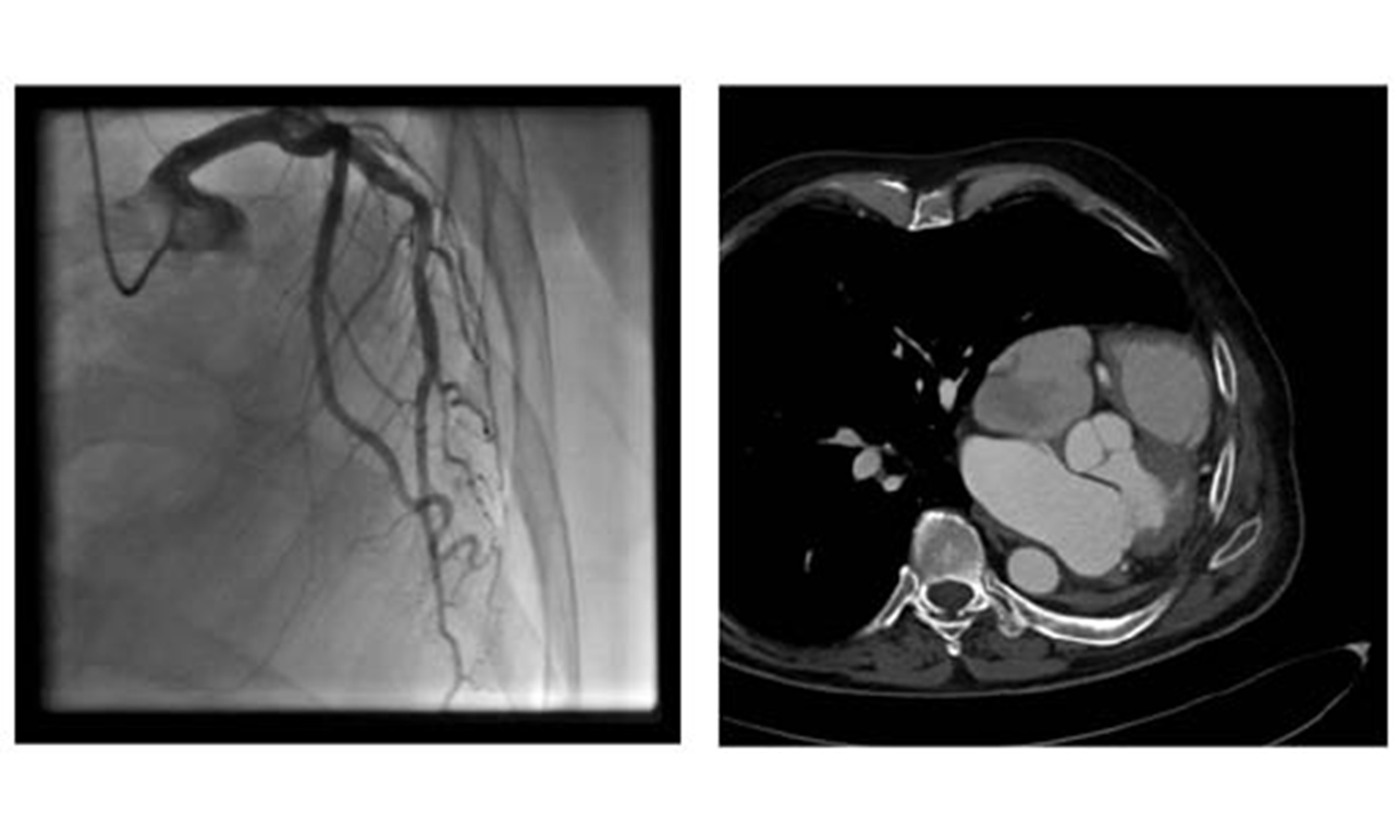 Edge-to-Edge Repair After Prior Left-Sided Pneumonectomy - European ...