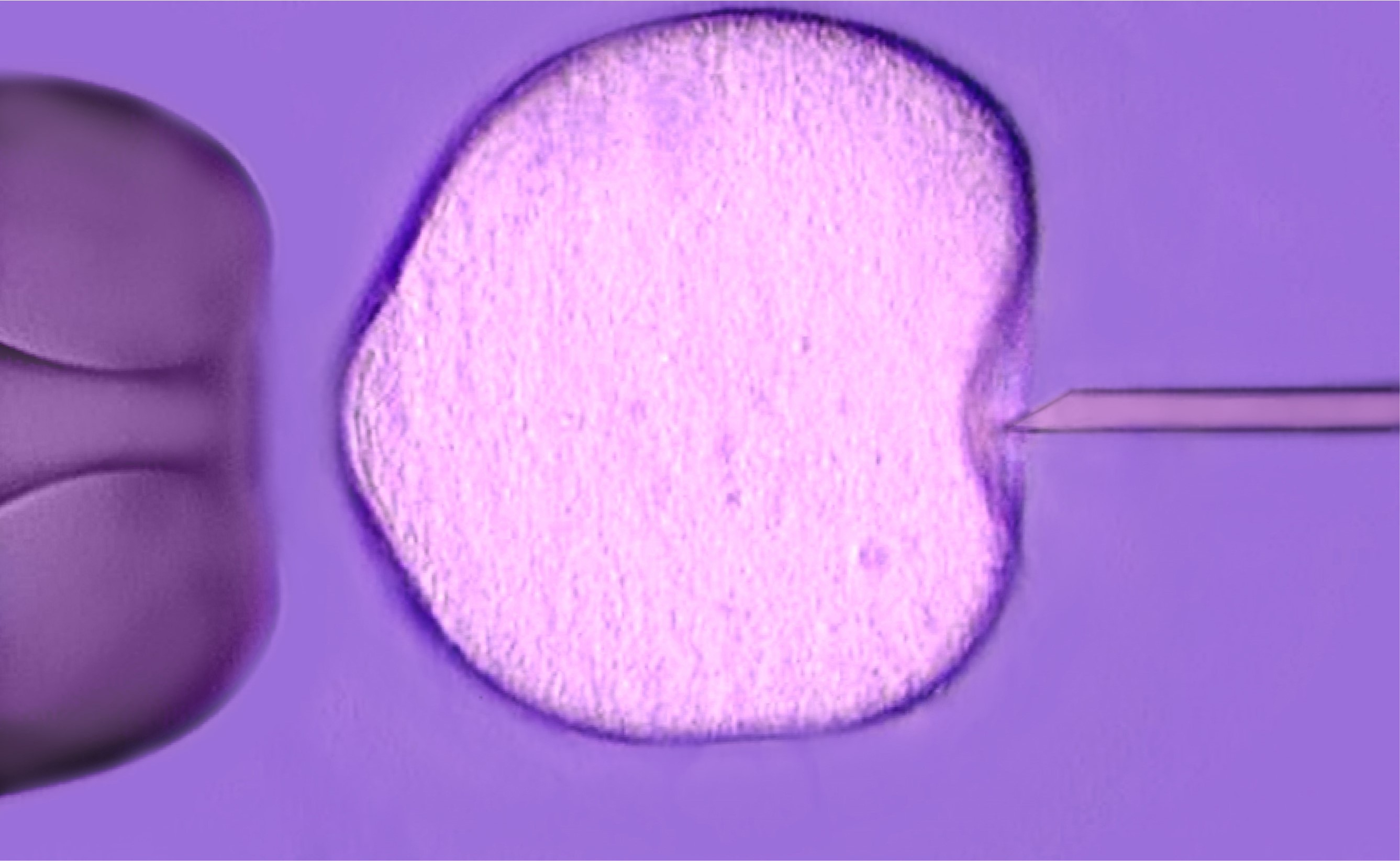 The benefits of Expanded Carrier Screening in IVF Research - EMG-Health