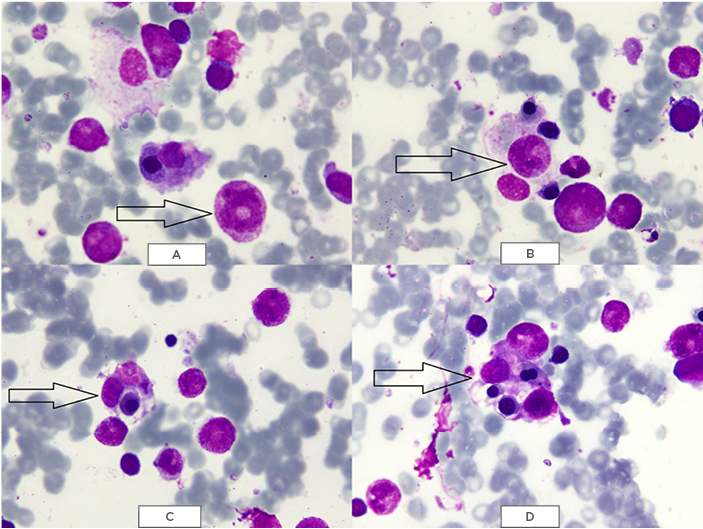 Adult-Onset Still’s Disease Complicated with Haemophagocytic ...