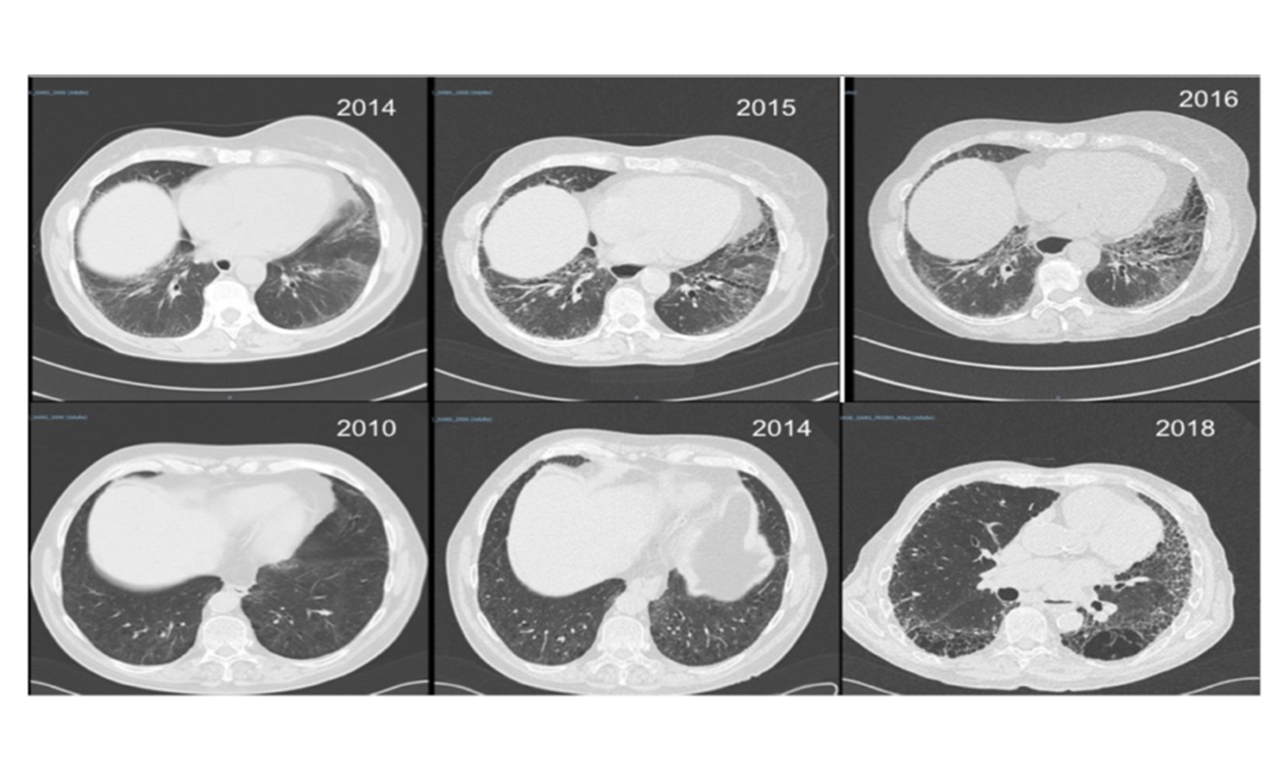 Systemic Sclerosis Ssc Review Rheumatology Emj Reviews