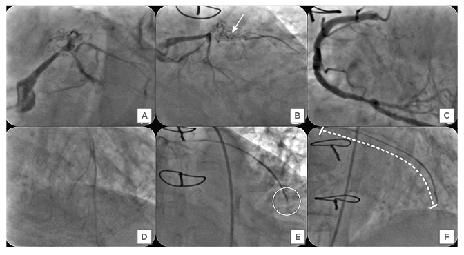Percutaneous Coronary Intervention of a Diffusely Degenerated Saphenous ...