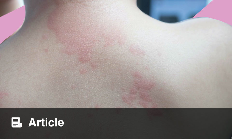 Urticaria Pigmentosa On Face PDF) Urticaria Pigmentosa: A Case Report