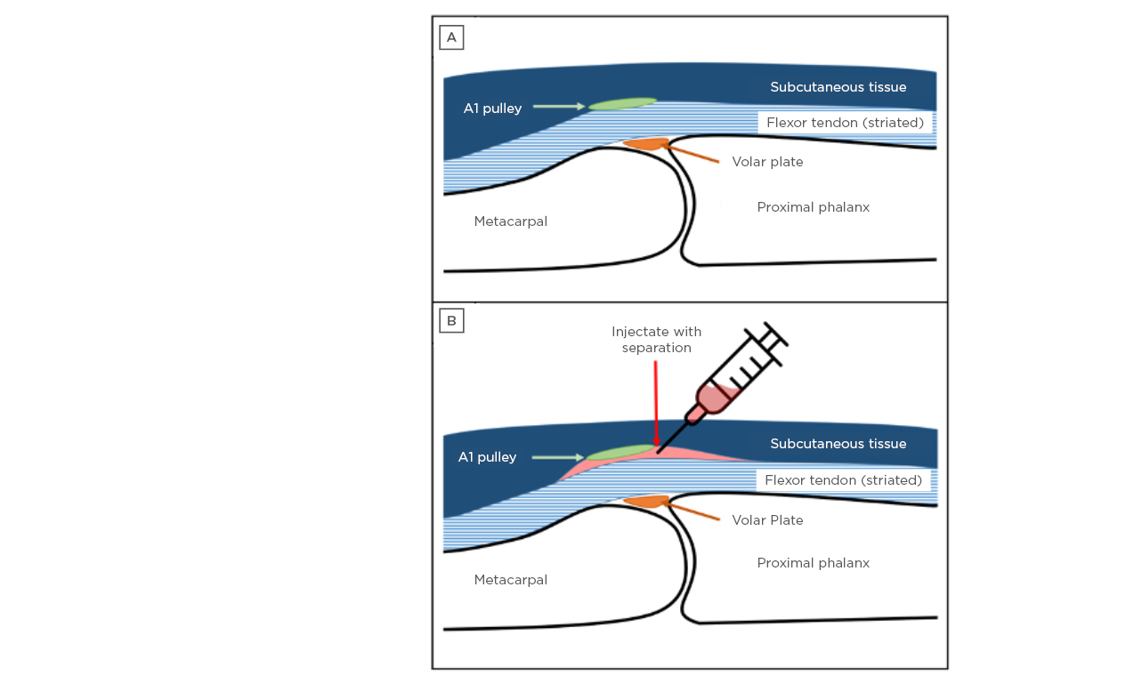 An Ultrasound Phantom for Stenosing Flexor Tenosynovitis - European ...
