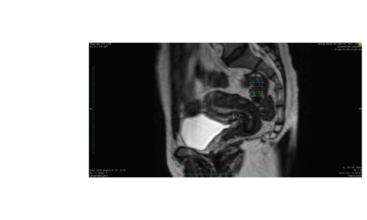 Sonohysterography: A Formidable Diagnostic Tool in the Evaluation of ...