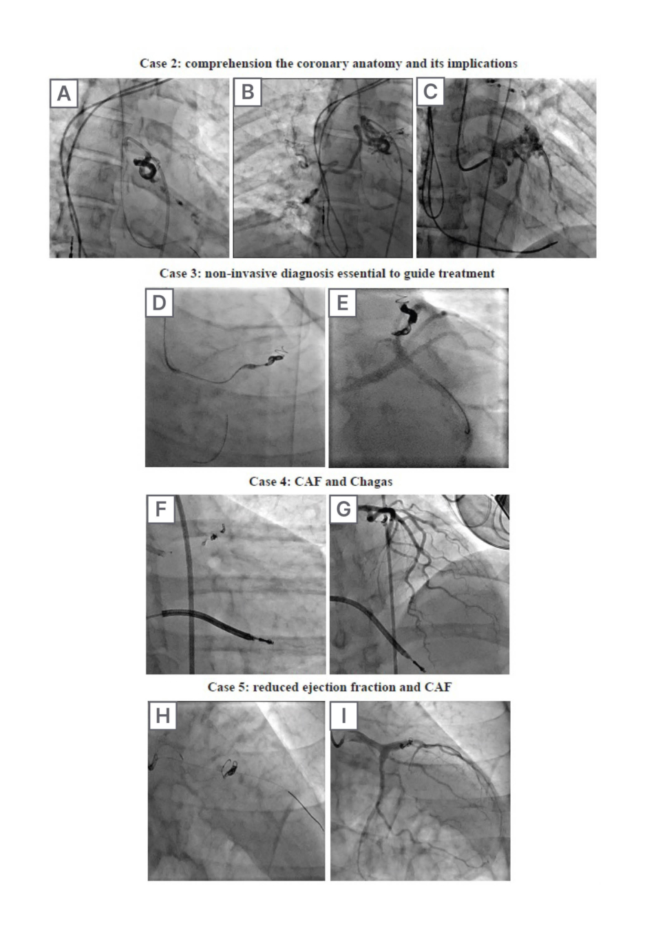 Should Coronary Artery Fistula Be Treated? A Review Throughout a Case ...