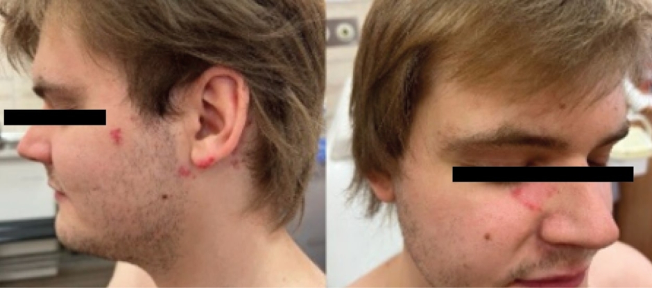 Chronic Cutaneous Lupus Erythematosus in a Patient with a History of ...