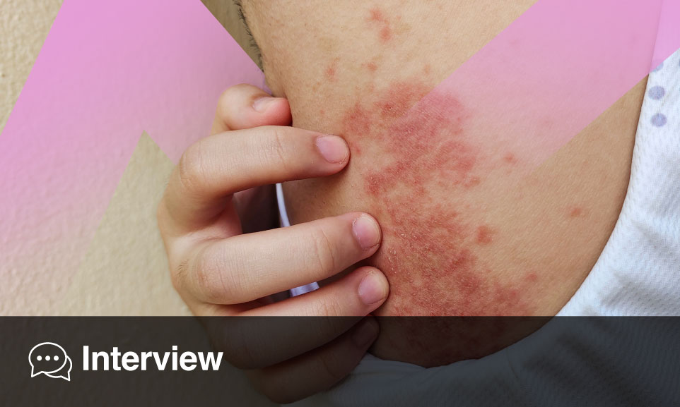 The Evolving Atopic Dermatitis Treatment Landscape - European Medical ...