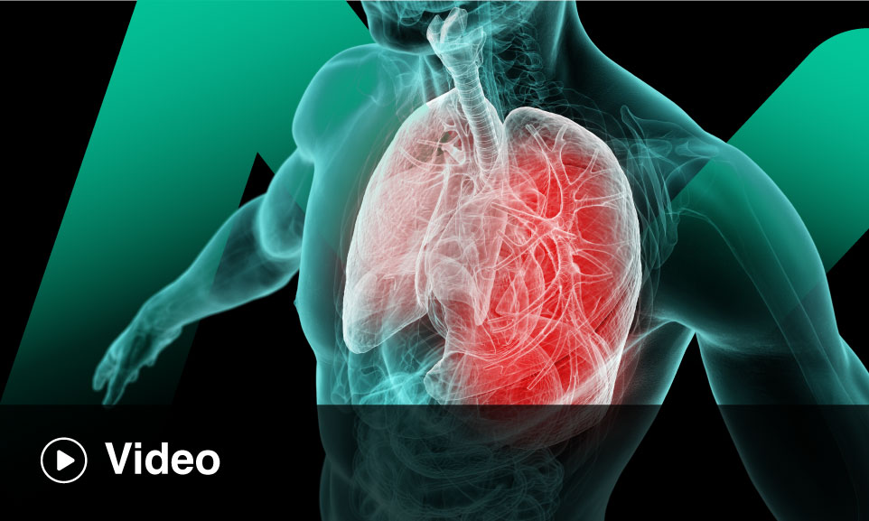 Understanding Missed and Delayed Bronchiectasis Diagnoses Through a ...