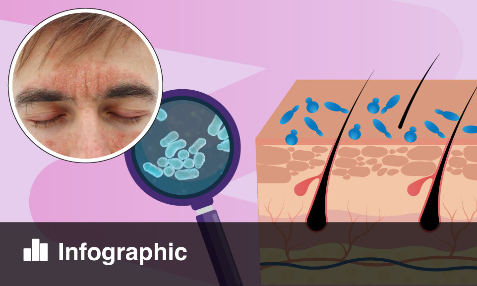 Seborrheic Dermatitis: New Pathophysiology Evidence and Therapeutic ...