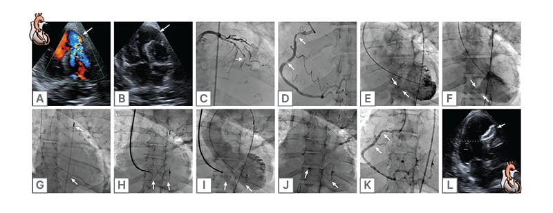 Emergency Transcatheter Closure of Post-Myocardial Infarction ...